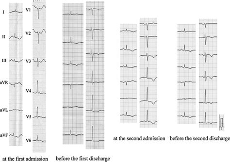 Recurrent Takotsubo Cardiomyopathy Can Appear As Transient