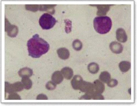 Original Acute Leukemia Image Figure 3a Shows The Results Of The S Download Scientific