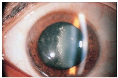 Ocular Presentations Of Amyloidosis Intechopen