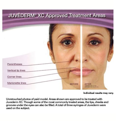 Juvederm Xc Clinique Dallas