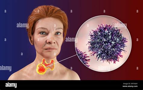 Thyroid Gland Cancer With Closeup View Of Cancer Cells Computer