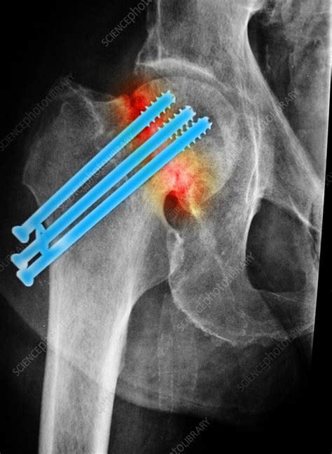 Repaired Hip Fracture Stock Image C009 4790 Science Photo Library