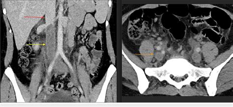 Coronal Left And Axial Right Contrast Enhanced Ct Images Show