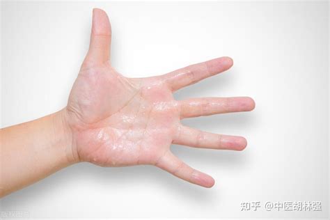 手汗阴虚，头汗心热，胸汗脾虚，半身出汗去医院。老中医教你看汗 知乎