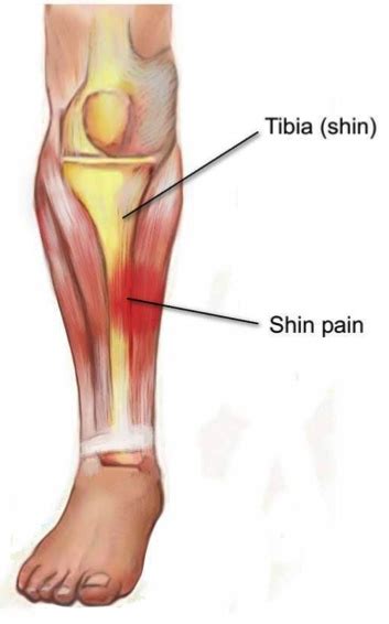 Shin Splints Rural Physio At Your Doorstep
