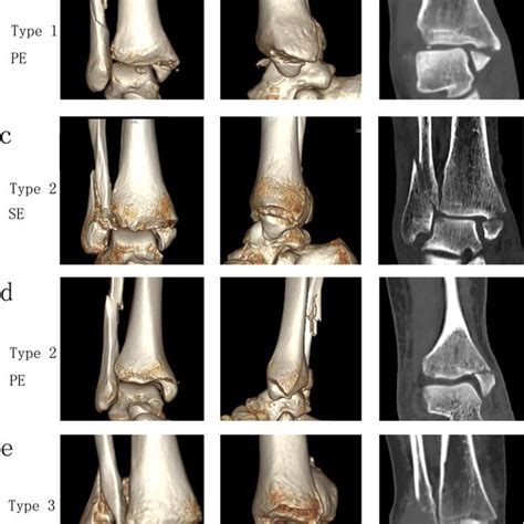 The Modified Pankovich Classification And The Herscovici Classification