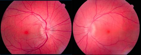 Ophthalmology Dx The Great Pretender Ophthalmology Advisor
