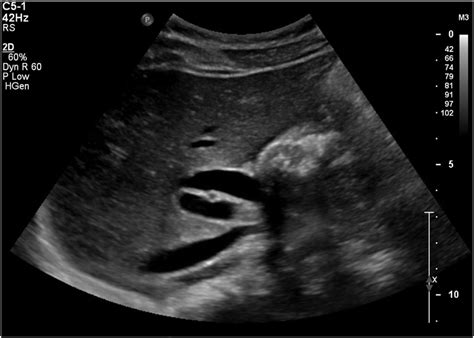 Bile Duct Dilation Symptoms
