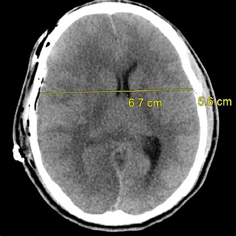 Head Ct Scan Post Decompressive Craniectomy On Day One Shows Developing