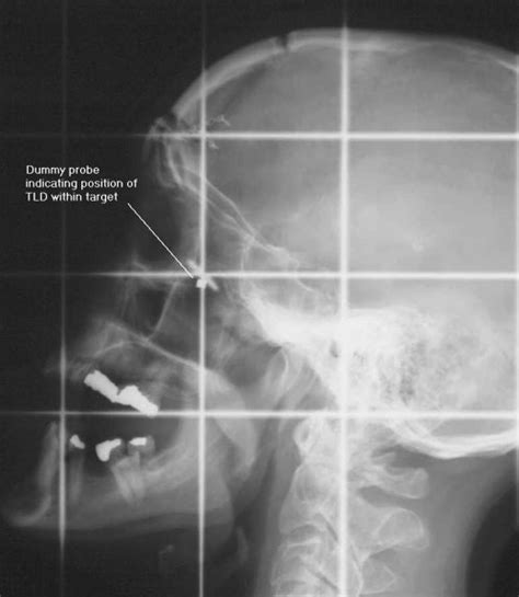 Thermoluminescent Dosimeter Tld Position For In Vivo Dosimetry Within