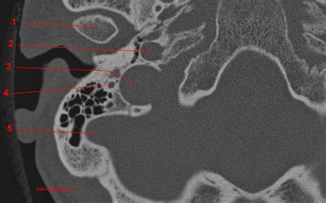 Ct Scan Of The Temporal Bone W Radiology