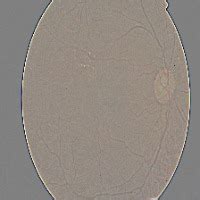 Diabetes Detection Classification Dataset And Pre Trained Model By Naslink