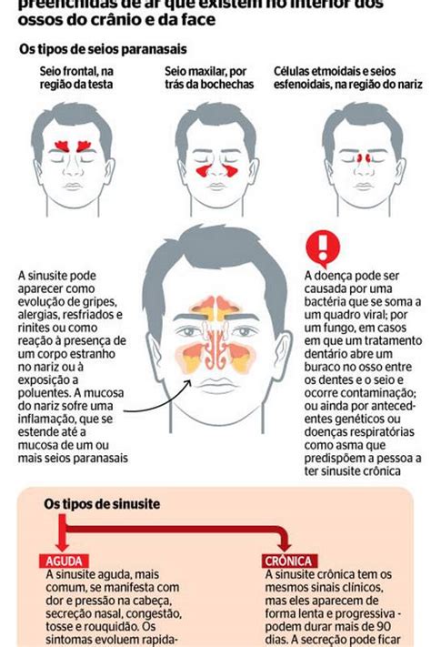 Sinusite o que é sintomas tipos causas tratamento lucox cl