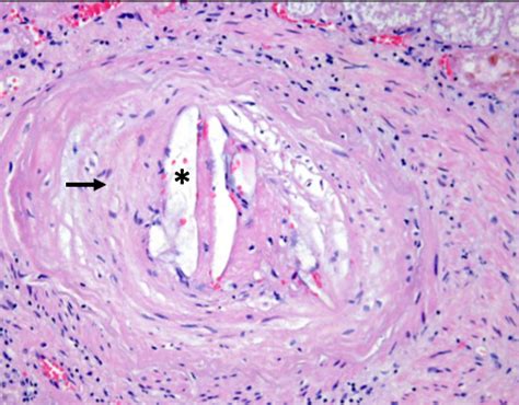 Figure Cholesterol Emboli In The Glomerulus Statpearls Ncbi