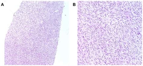 Pathological Examination Of Tumor A Hematoxylin Eosin Staining Is