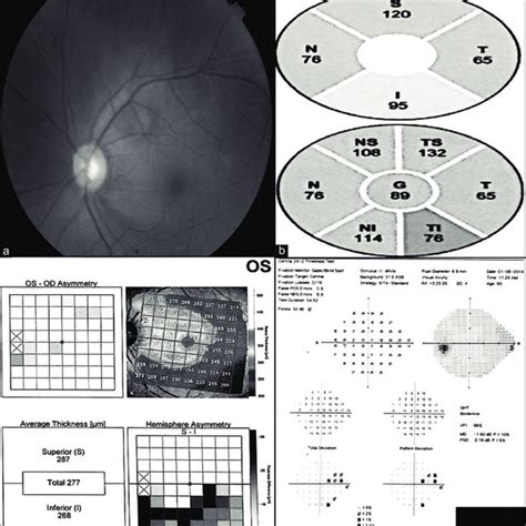 Oct Image Of The Temporal Sclera A Ciliary Muscle B Scleral Spur Download Scientific