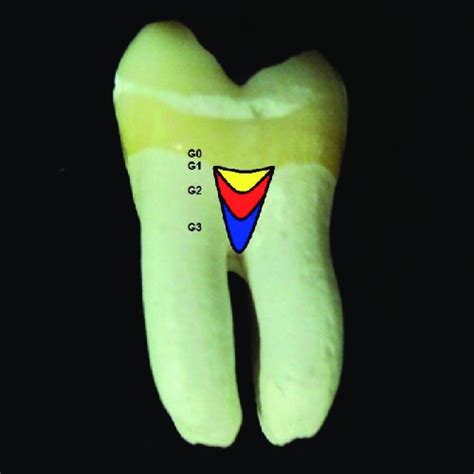 Pdf Prevalence Of Cervical Enamel Projection In Human Molars
