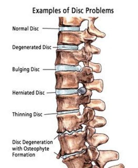 Slipped Disc Jaw Joint Abigail Abraham