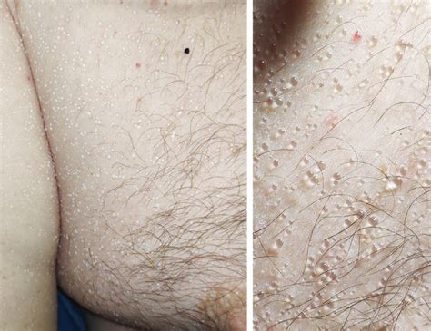 Icu Patients Sudden Vesicular Rash Medical Osces