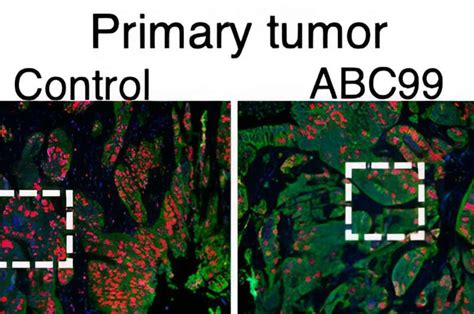 Genetic Switch Turns Tumor Suppressor Into Oncogene In Colorectal