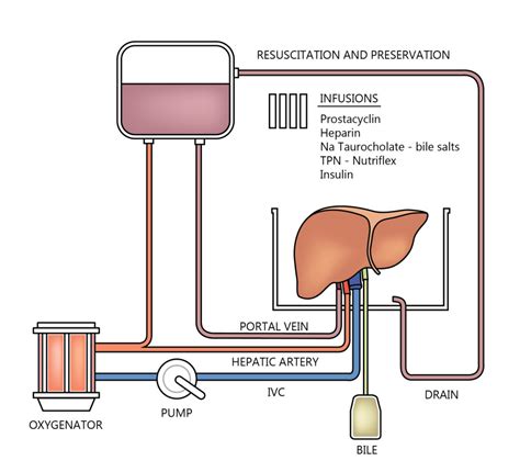 Preliminary Single Center Canadian Experience Of Human Normothermic Ex