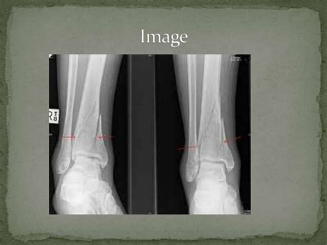 Pilon Fracture PPT