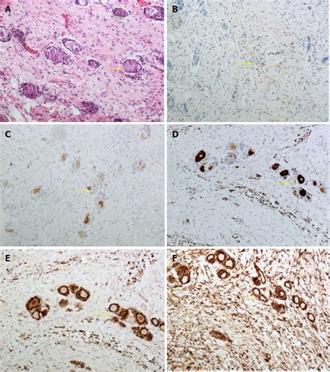 Histopathology Of The Resected Lesion A Hematoxylin And Eosin