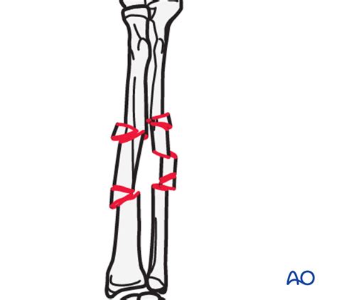 Multifragmentary Fragmentary Segmental Fracture Of Both Bones