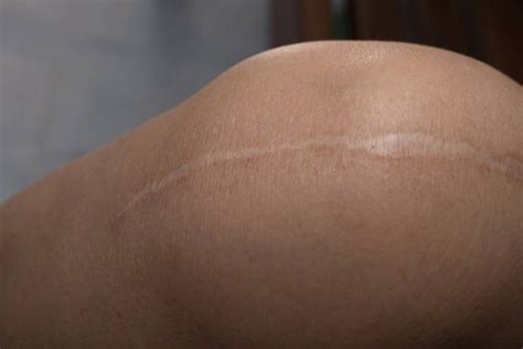 Keloid Stock Photos Royalty Free Keloid Images Depositphotos