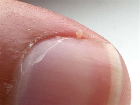 Hangnails What Are They And How To Prevent Them
