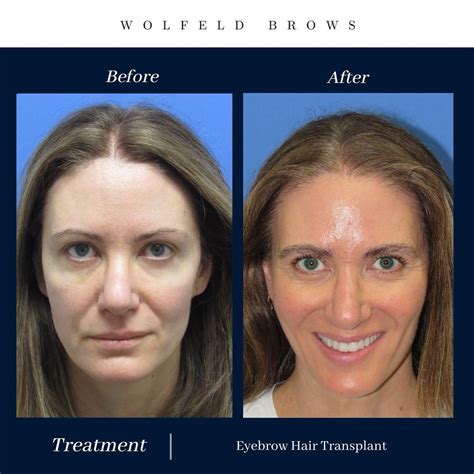 Here Are Two Before And After Photos Showcasing Excellent Results For One Of Our Recent Patients