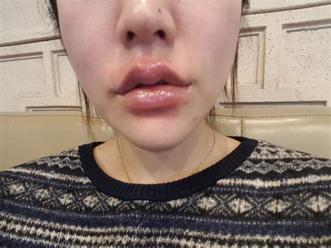 입술필러 솔직 후기 1편 시술 전~시술 직후사진영상 네이버 블로그