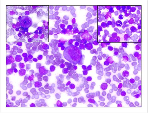 Bone Marrow Aspirate Showing Numerous Plasma Cells Intranuclear