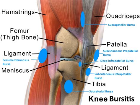 Lateral Bursitis Knee