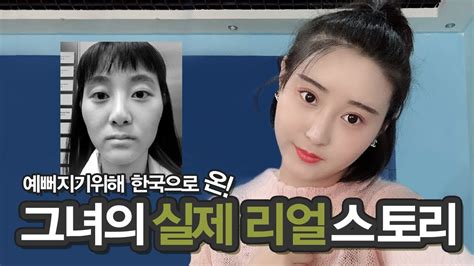 눈 코 성형 지앙의 리얼스토리 [4월31일성형외과] Youtube