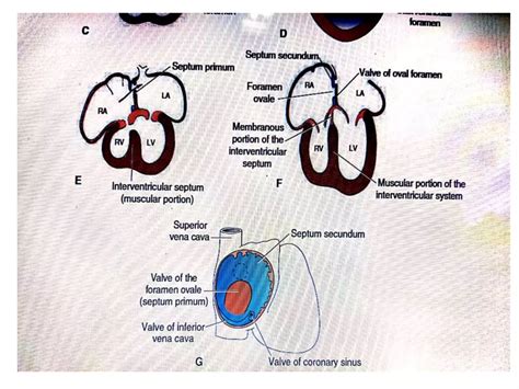 Atrioventricular Canal Defect Ppt