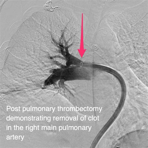 Pulmonary Artery Thrombectomy And Thrombolysis Pe Treatment