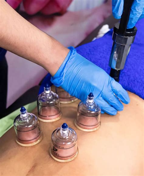 Cupping Therapy