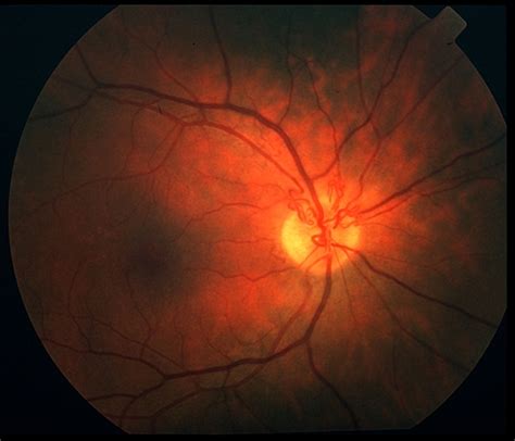 Congenital Prepapillary Arterial Malformation Retina Image Bank