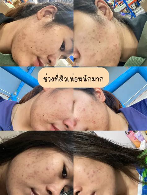 แชร์ประสบการณ์รักษาสิวที่สถาบันโรคผิวหนัง แกลเลอรีที่โพสต์โดย