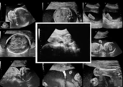 Us Obstetric Fetal Anatomy Scan Anomaly Scan The Fetal Medicine