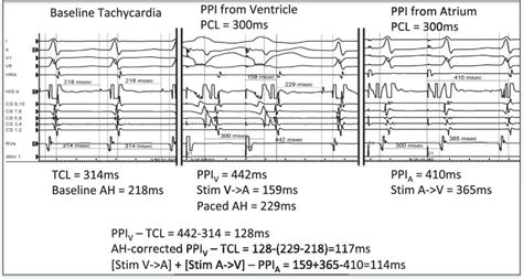 Example Of Using Time Intervals Obtained During Atrial And Ventricular Download Scientific
