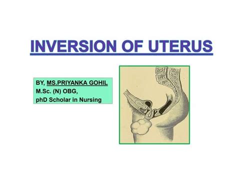 Uterine Inversion