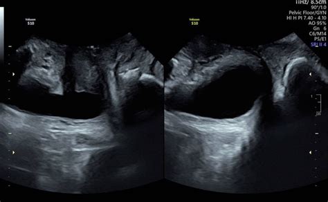 Ics 2021 Abstract 121 Usability Of Transperineal Ultrasound For The