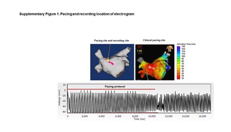 Spatial Changes In The Atrial Fibrillation Wave Dynamics After Using