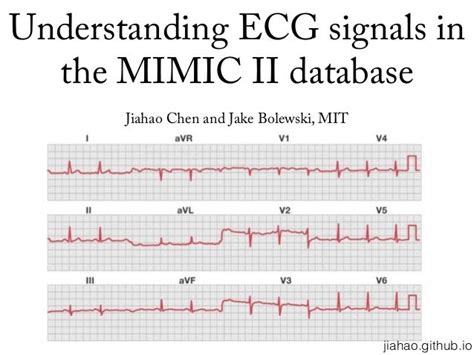understanding ecg signals in the mimic ii database