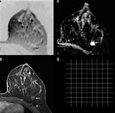 Efficacy Of High Resolution 3 D Diffusion Weighted Imaging In The Detection Of Breast Cancer