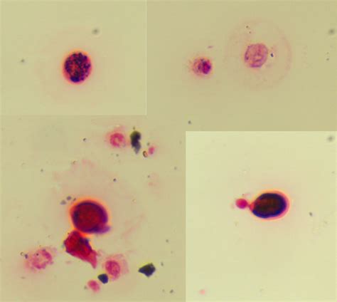 Strange Microorganisms In Csf Gram Stain Of Meningitis Patient