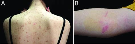 Clinical Photography A Diffuse Pink To Brown Macules With Crusts And Download Scientific