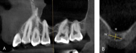 Gamal Elsayed On Linkedin The Impact Of Maxillary Sinus Pneumatization